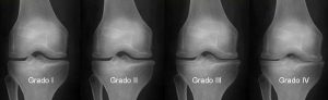 Conoce los grados de la artrosis de rodilla