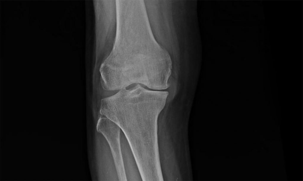 Rotura de Menisco: Recupérate sin cirugía | Clínica Cellus